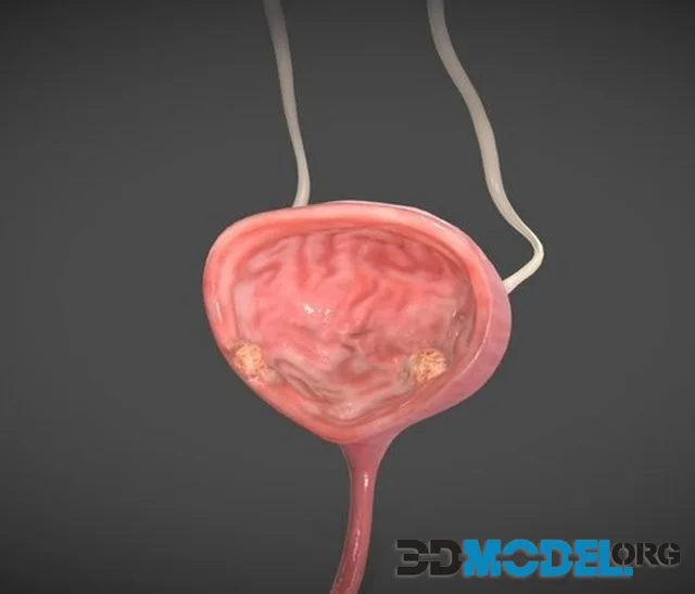 3D Model – Bladder Cancer