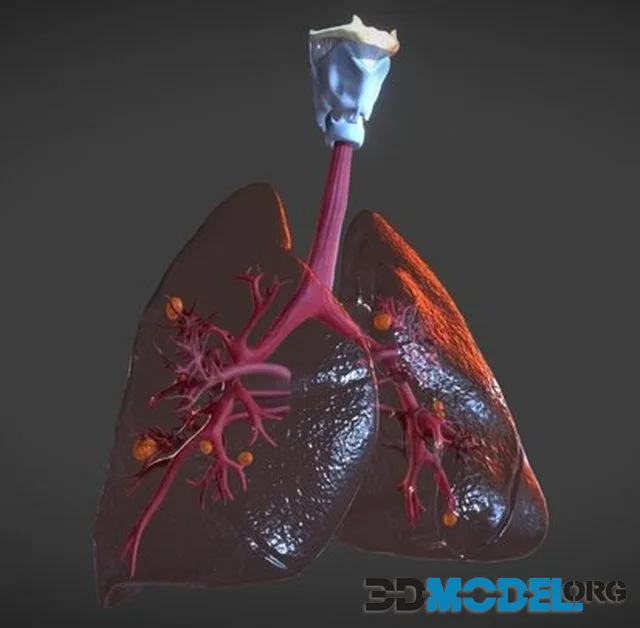 3D Model – Lung Cancer