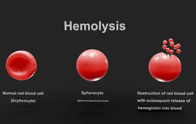 3D Model – Hemolysis (PBR)